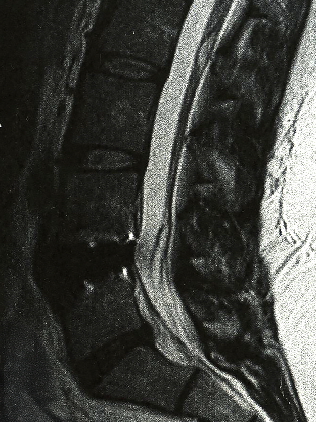BAGUERA® L - Spineart